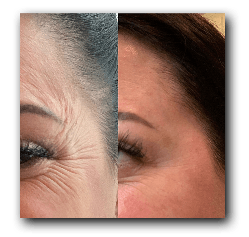 Botox | MD Esthetics