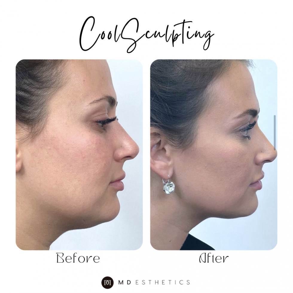 CoolSculpting | MD Esthetics