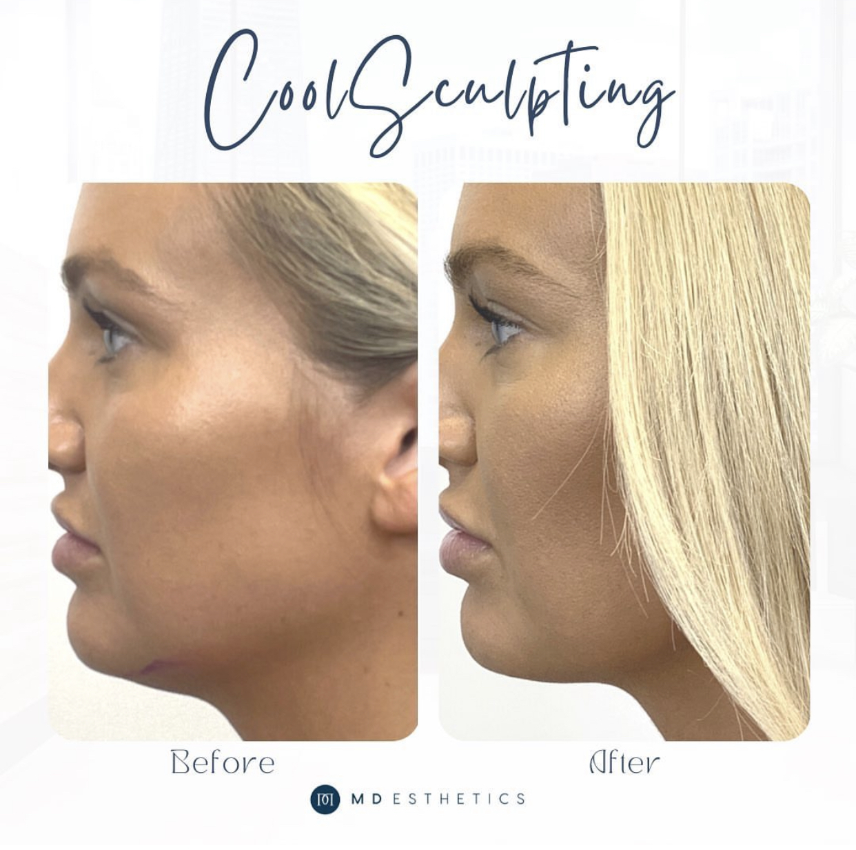 CoolSculpting | MD Esthetics