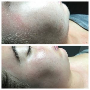 Facials Service - MD Esthetics