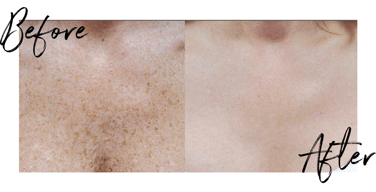 IPL PhotoFacial | Windham, NH | MD Esthetics