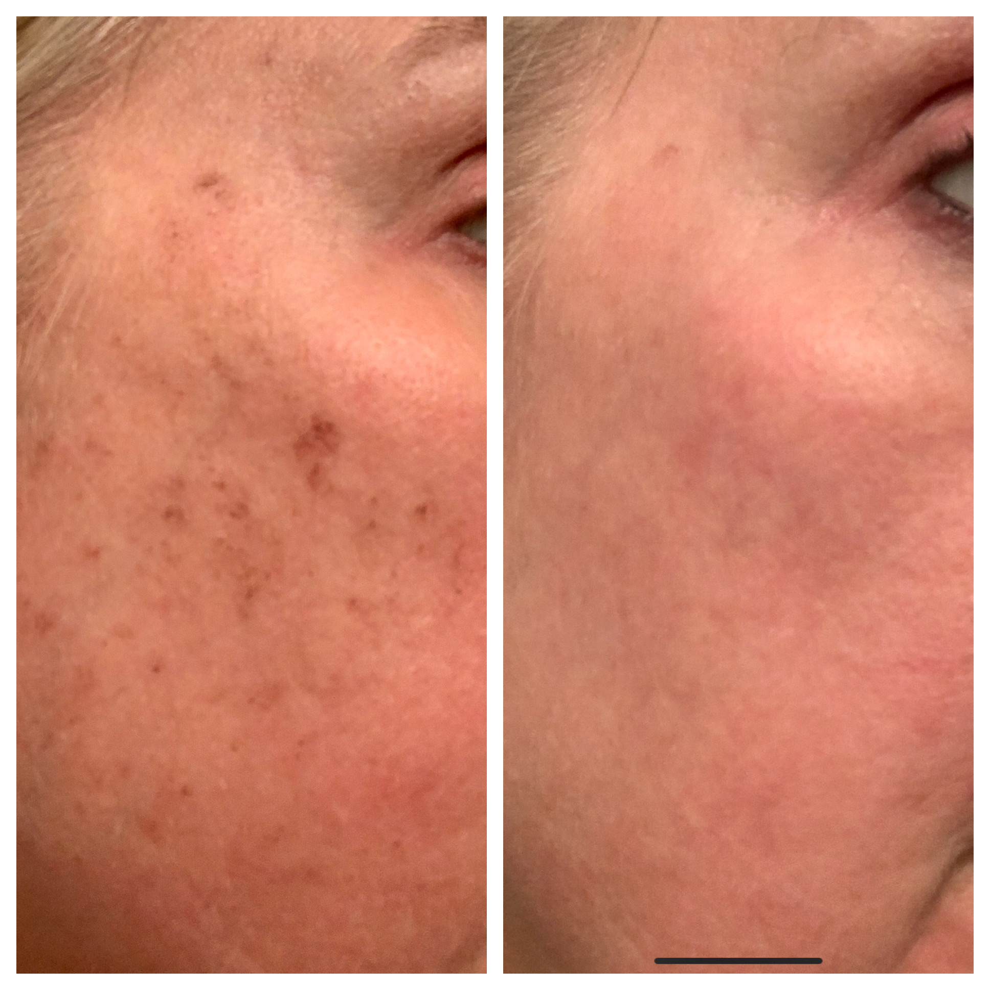 IPL Photofacial | MD Esthetics