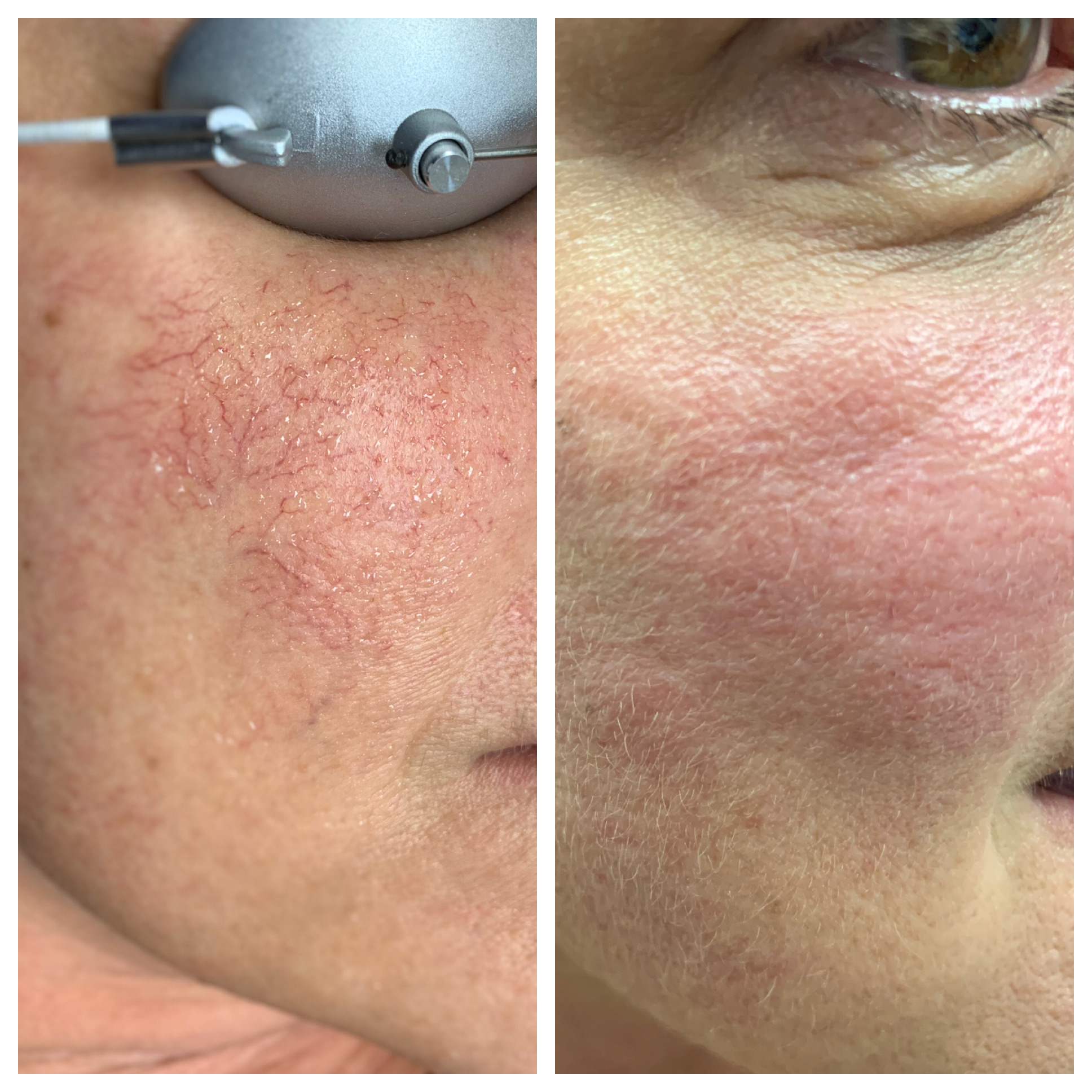 IPL Photofacial | MD Esthetics