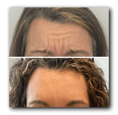 Botox | MD Esthetics