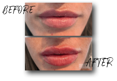 Dermal Fillers | MD Esthetics
