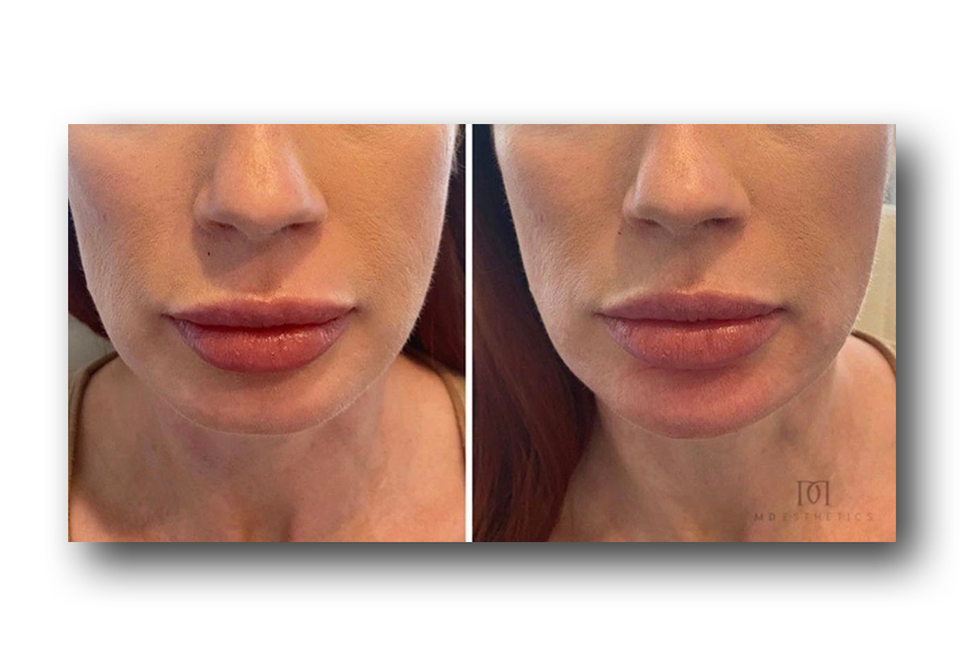 Dermal Fillers | MD Esthetics