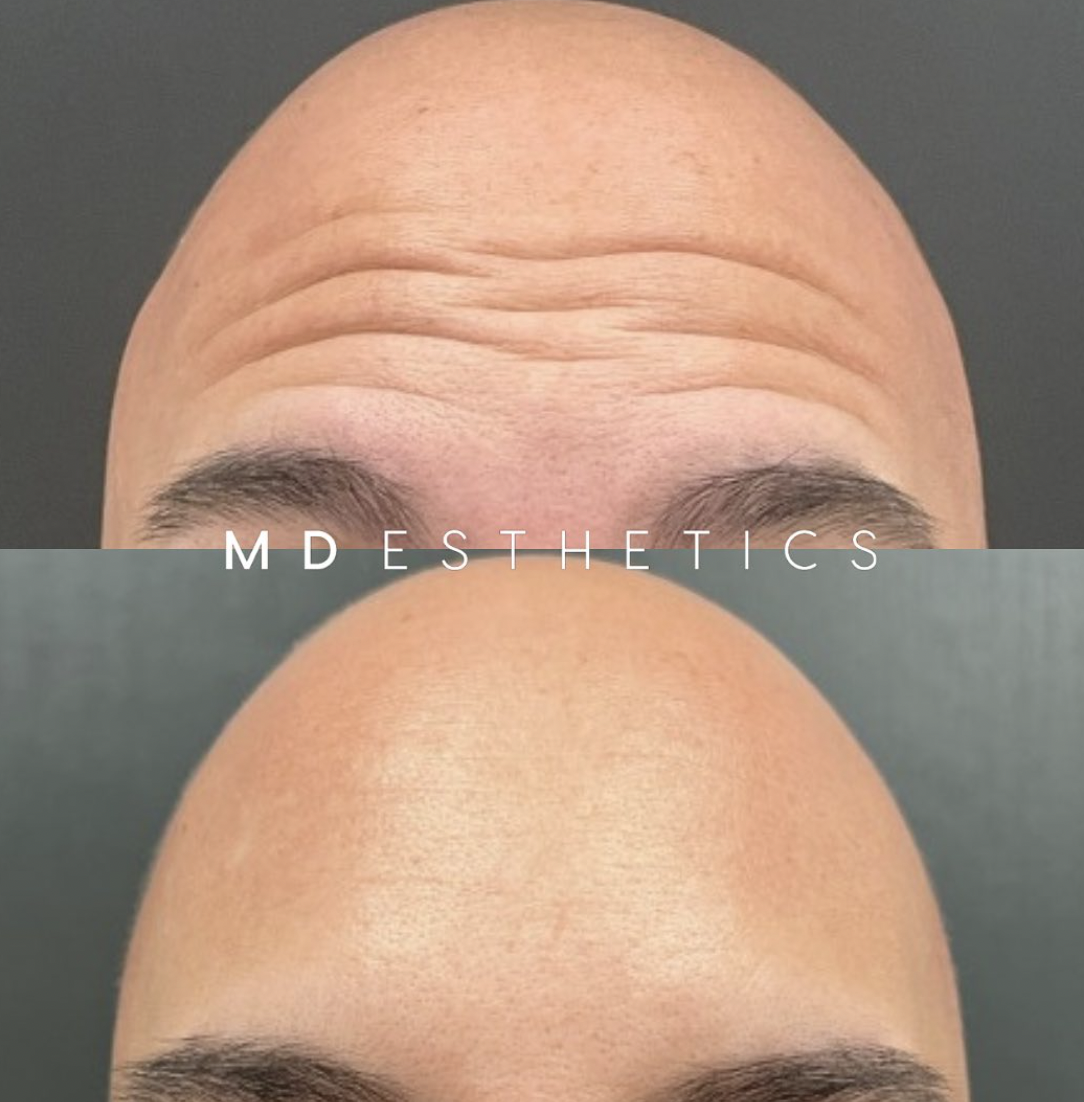 Botox - MD Esthetics